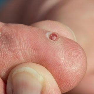 Pyogenic Granuloma - Azalea Skin Treatment Center | Garner, NC ...